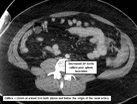 ショックの画像診断/CT hypoperfusion complex｜TKG画像診断