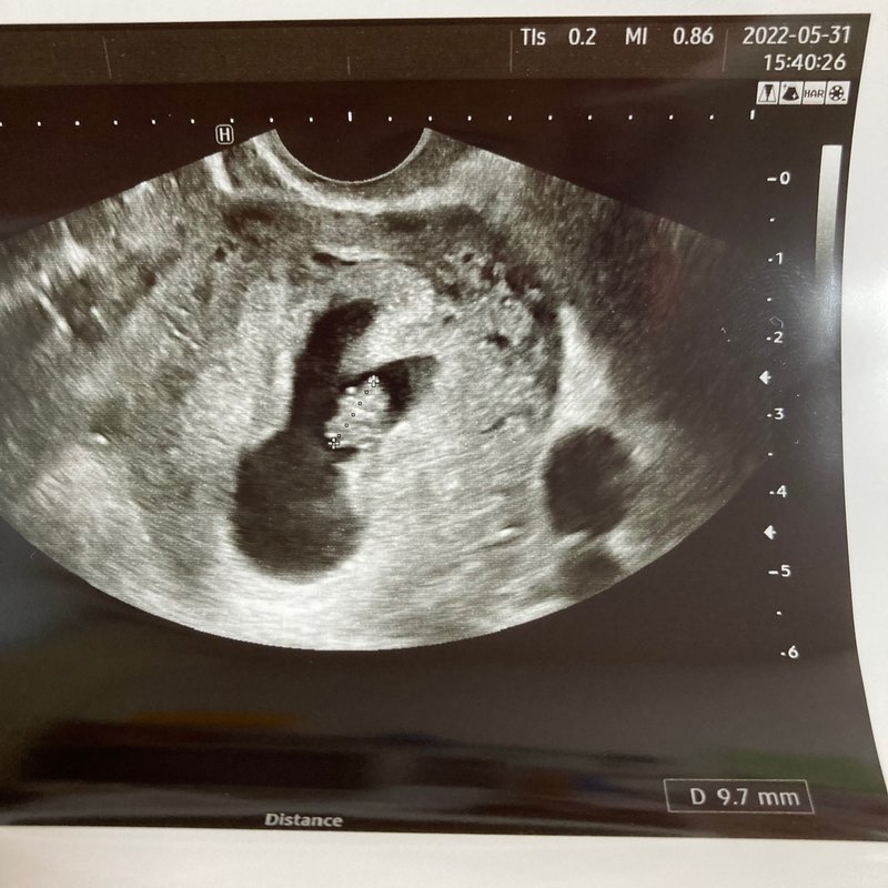 【2人目妊活】BT31 klc 心拍確認7w1d｜にこ天使ママ