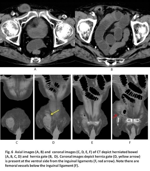 鼠径ヘルニアと大腿ヘルニアの楽な鑑別法｜TKG画像診断