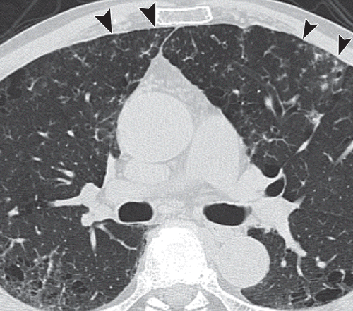 Sjögren症候群の胸部CT｜TKG画像診断