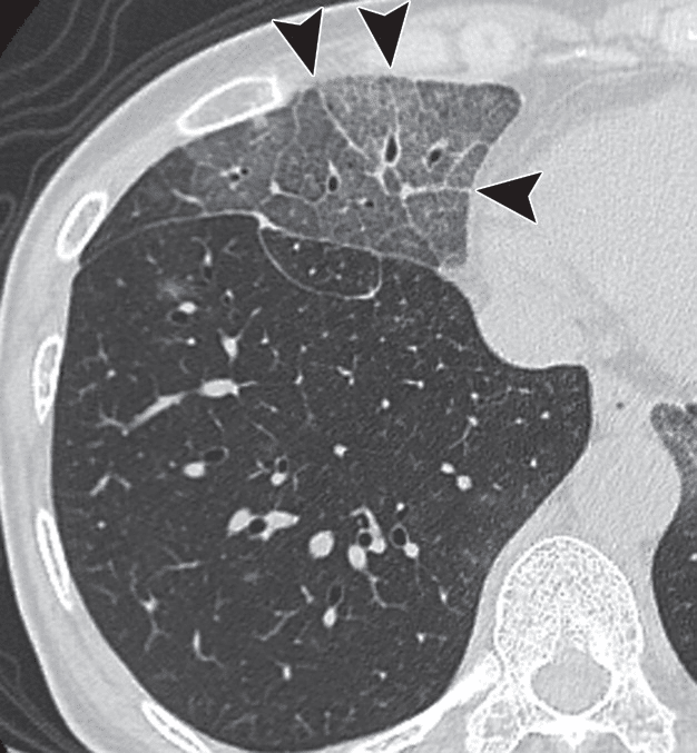 Sjögren症候群の胸部CT｜TKG画像診断