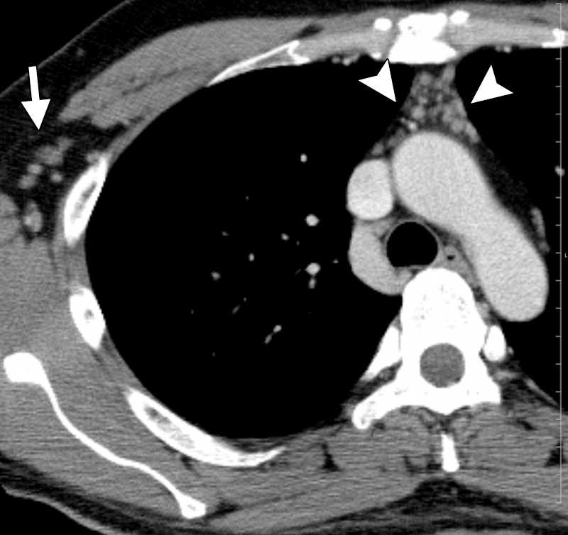 Sjögren症候群の胸部CT｜TKG画像診断