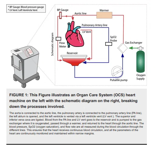 TMDX OCS Heart 米国クリニックにおける使用レポートの紹介｜のひ