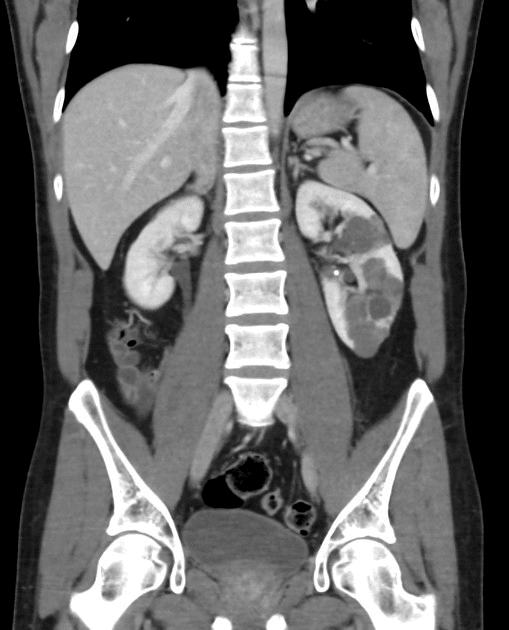 localized cystic kidney disease｜TKG画像診断