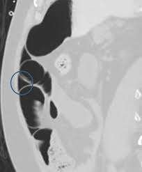 Telltale triangle sign｜TKG画像診断