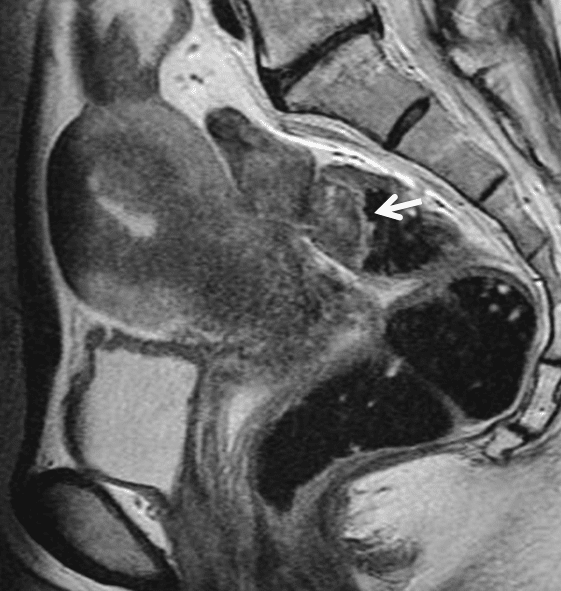 mushroom cap sign｜TKG画像診断