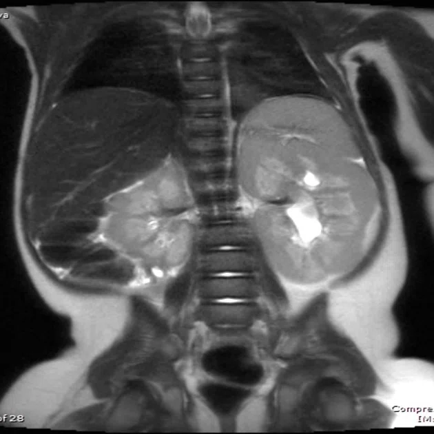 diffuse nephroblastomatosis｜TKG画像診断｜note