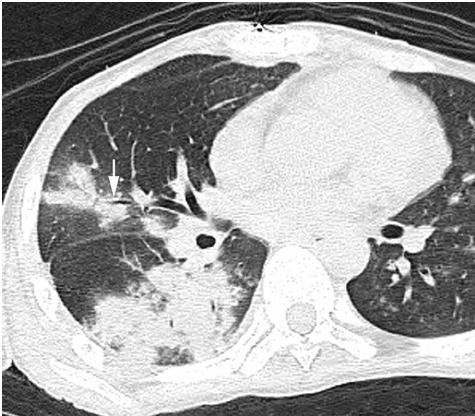 緑膿菌肺炎｜TKG画像診断｜note