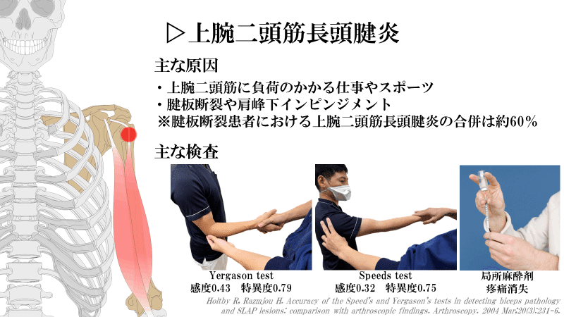 上腕二頭筋長頭腱炎 病態・理学療法ポイント |肩関節機能研究会 郷間