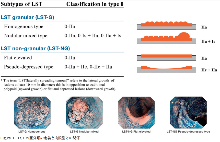 内視鏡専門医試験対策ノート（3）2022年2月の過去問分析（下部＋胆膵）｜内視鏡専門医試験対策【DrY】