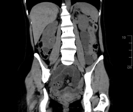 食餌性腸閉塞のCT｜TKG画像診断
