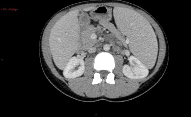 granulomatous lymphocytic interstitial lung disease（GLILD）｜TKG画像診断
