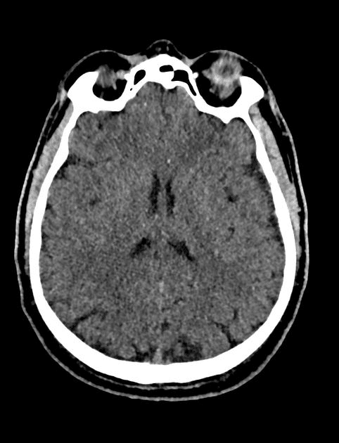 Calcified trochlear apparatus｜TKG画像診断