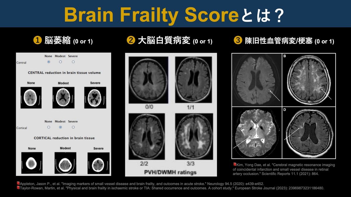 脳フレイル（Brain Frailty）｜Super Human | 理学療法士／保健学博士 Ph.D.