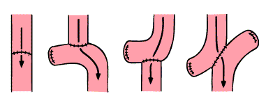 \周りと差をつける／シャント吻合のあれこれ｜maon@透析臨床工学技士