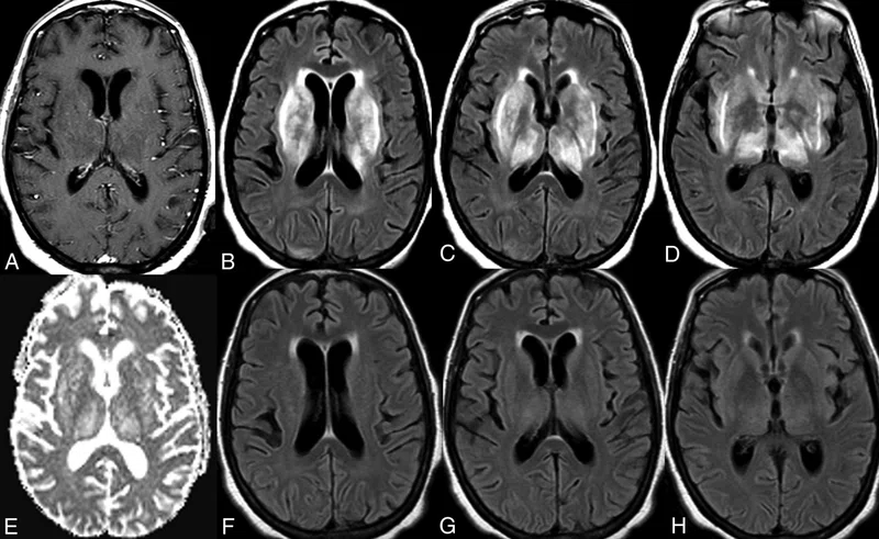 NPSLE: neuropsychiatric SLE｜TKG画像診断