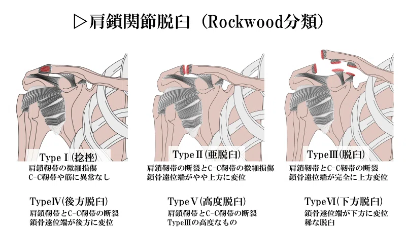 【定期購読版】肩鎖関節脱臼で押さえておくべき理学療法評価と指導ポイント｜肩関節機能研究会 郷間