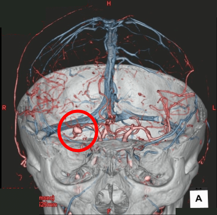くも膜下出血 #6-1｜脳卒中リハビリテーション看護認定看護師の脳の中