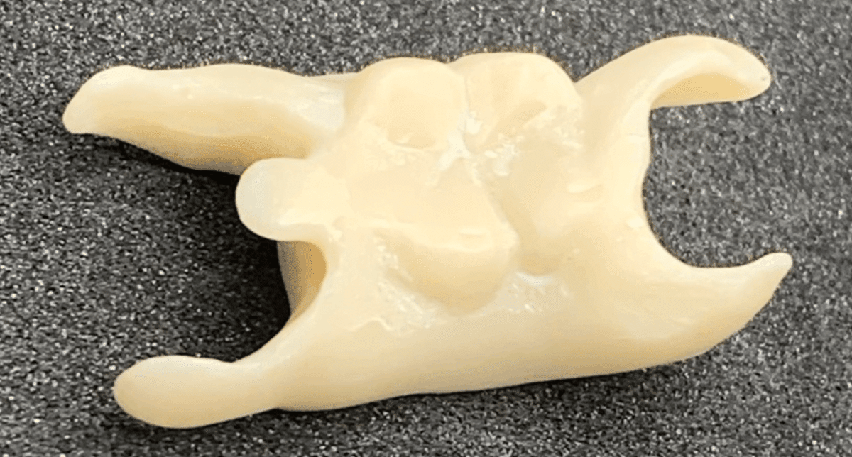 Medit SplintとMedit Designを使用したパーシャルデンチャー作成の方法（歯のデジタル抜歯方法は無料公開中） 2023年11 ...