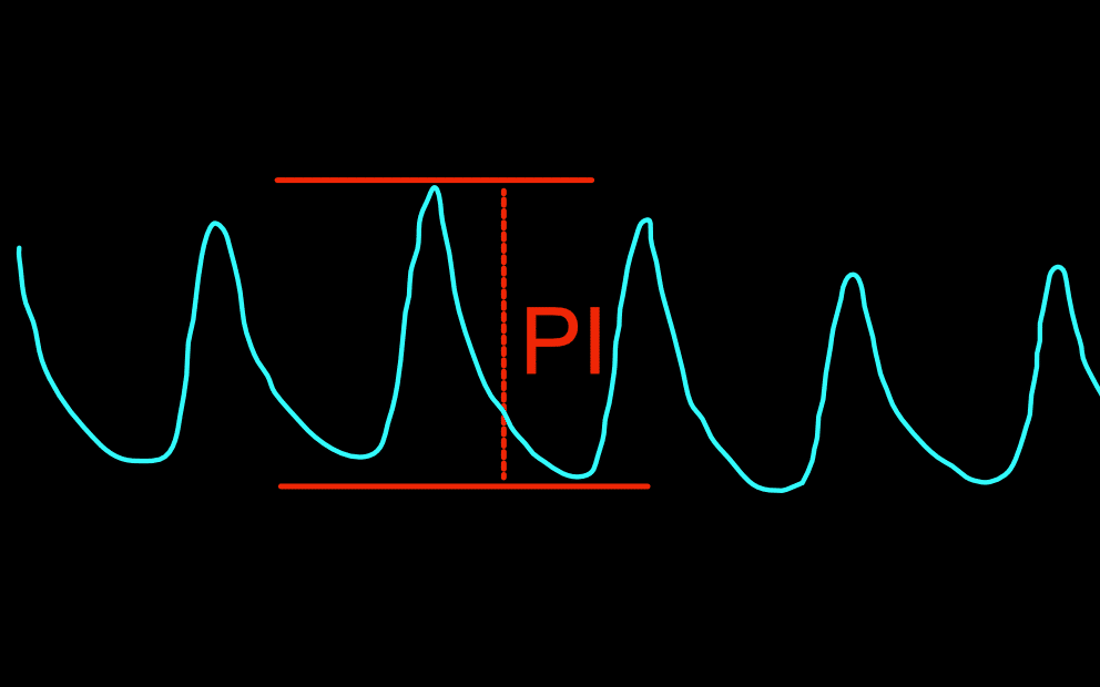 [サンプル版]Perfusion Index基礎・総論編。PIとはなにか。硬麻ブロックの効果判定や輸液反応性、体温管理にも（麻酔ICU等プロ向け記事）｜KCP ニッチな麻酔科ライター