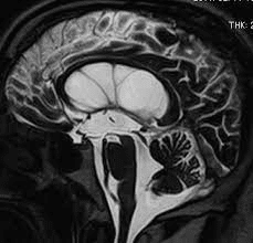 Panventriculomegaly with a wide foramen of Magendie and large cisterna ...