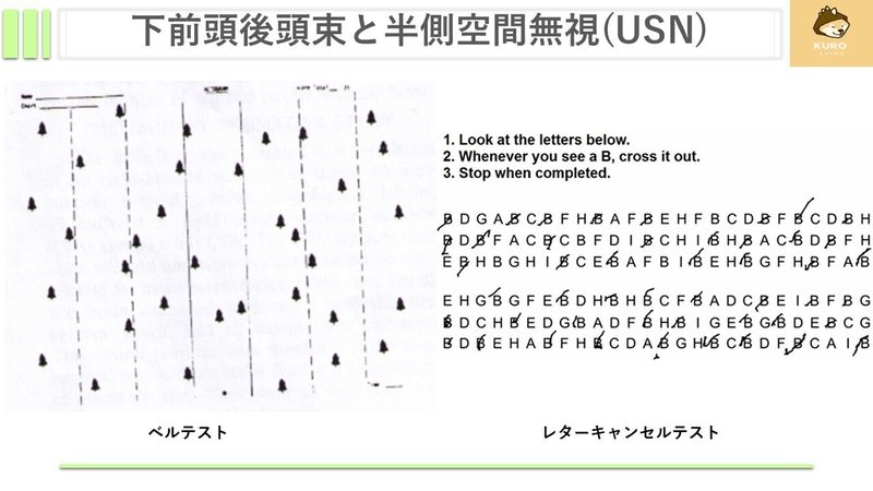 下前頭後頭束(IFOF)について｜くろ 作業療法士