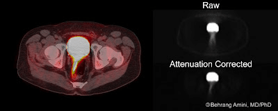 Perirectal Artifact【FDG PET/CT】｜TKG画像診断