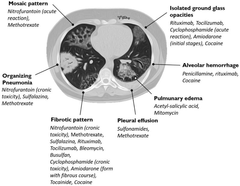 薬剤性肺障害のCTパターン｜TKG画像診断