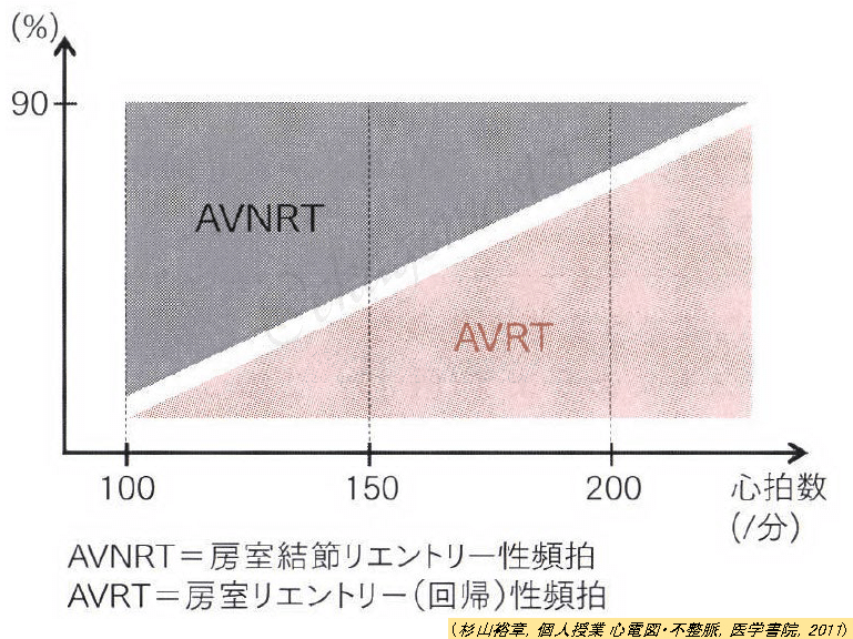 Dr.ヒロのおさらい心電図No.9～AVNRT vs. AVRT～ ｜えかげますたぁ｜Dr.ヒロ