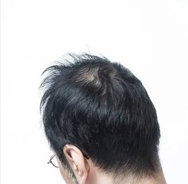 セルフAGA治療の全てを話す｜Toshiki