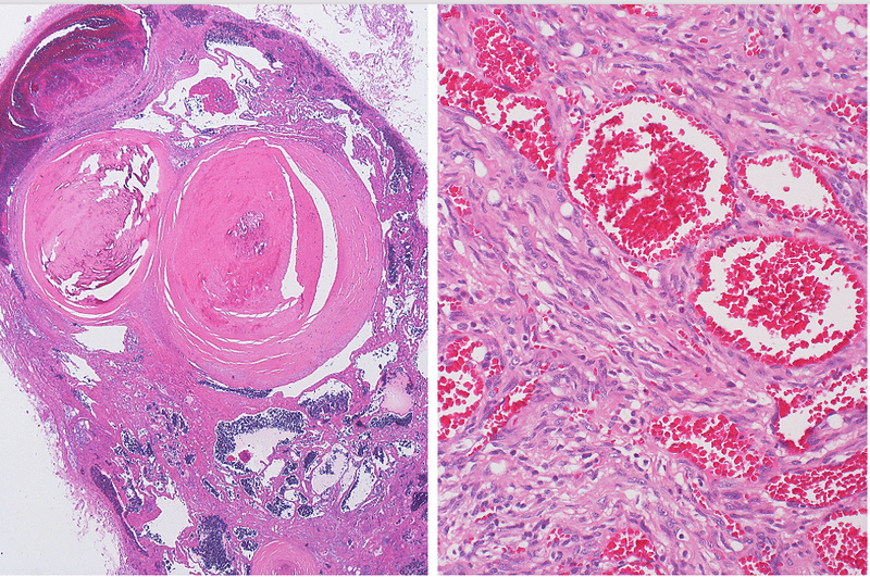 基礎：血管腫 hemangioma とその周辺｜形態屋染乃介