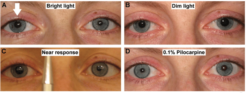 瞳孔が緊張する？Adie症候群｜脳神経内科医 カテ