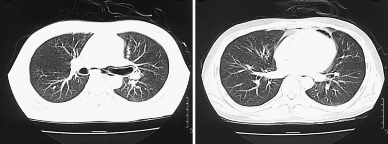 Hamman症候群とHamman syndrome｜TKG画像診断