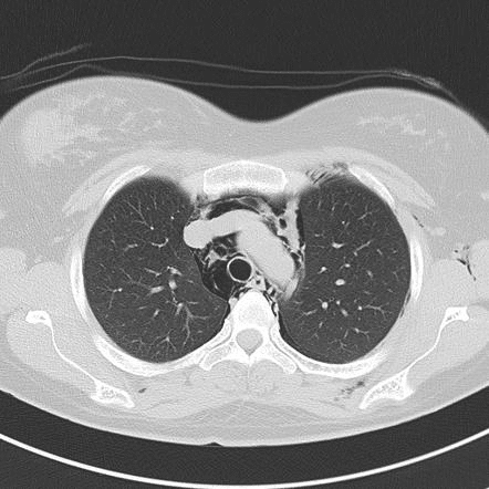 Hamman症候群とHamman syndrome｜TKG画像診断