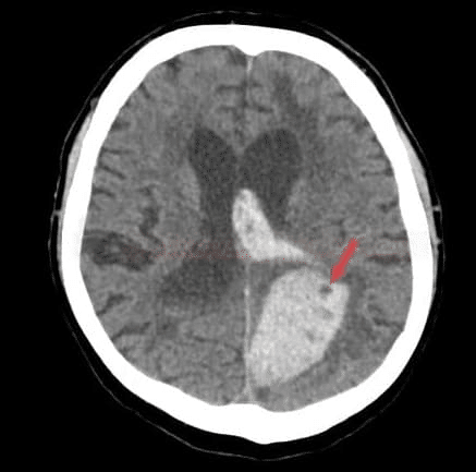単純CTで血腫増大を予測する所見一覧｜TKG画像診断