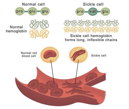 Casgevy and Lyfgenia – why they are milestones and why they are just ...