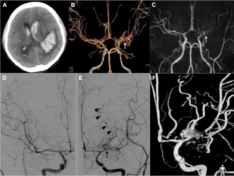 Twig-like MCA/RETE M1 anomaly｜TKG画像診断