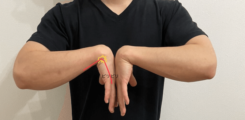 手根管症候群(carpal tunnel syndrome:CTS)｜あひるOT