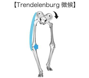 変形性膝関節症の臨床評価とアプローチ【サブスク】｜理学療法士による臨床のためのnote