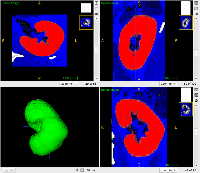 ITK-SNAPを使った3D DICOMイメージのセグメンテーション（誰トク？）｜sojin