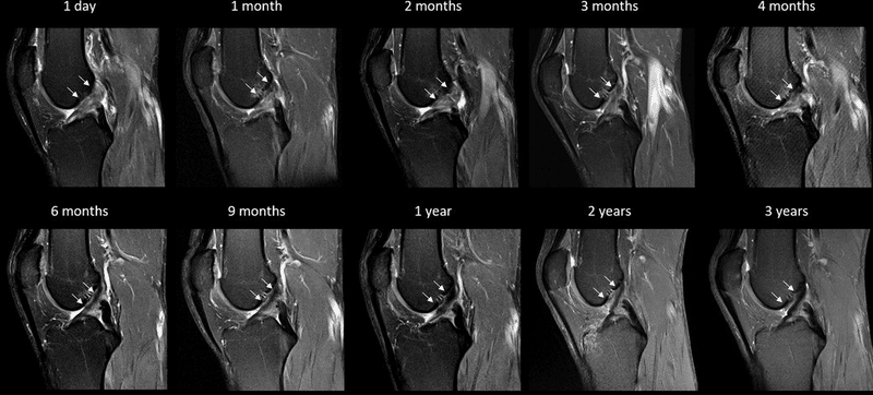 20240213：膝ACL損傷｜Brain storm conditioning 〜 脳からコンディショニング
