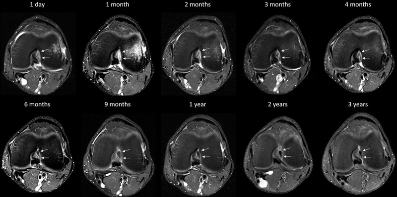 20240213：膝ACL損傷｜Brain storm conditioning 〜 脳からコンディショニング