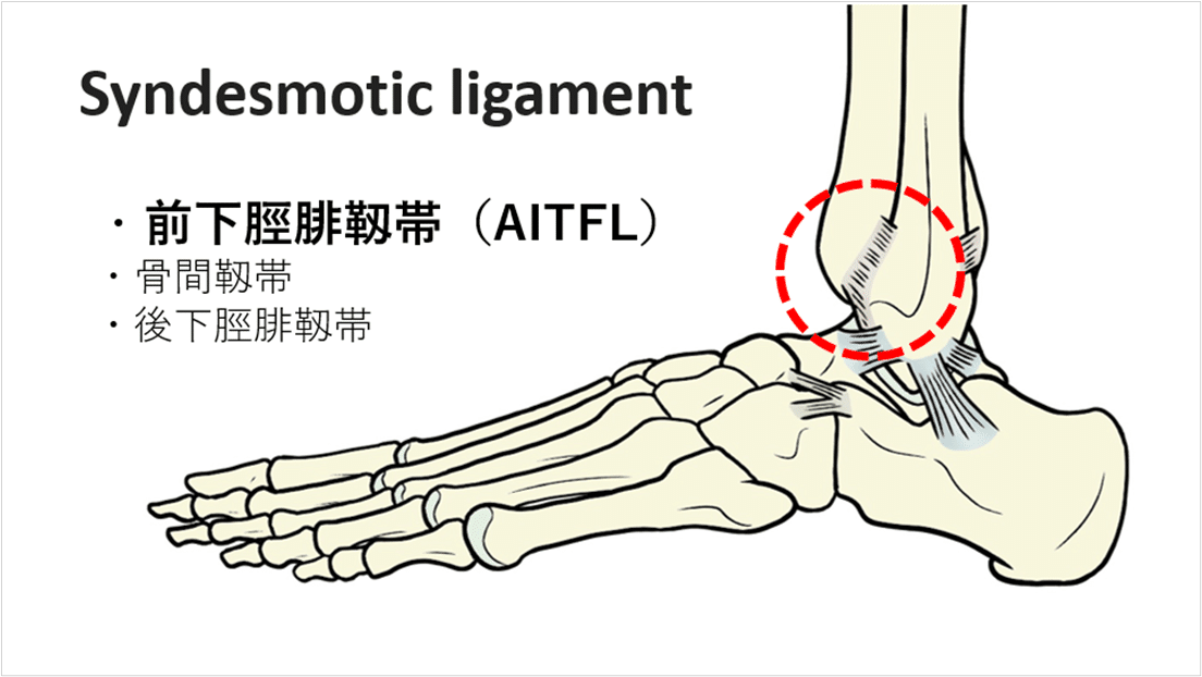 捻挫で必ず評価するべき部位 前下脛腓靭帯損傷を見逃すな！ ～不安定性や変形リスクの増大～｜Y.K