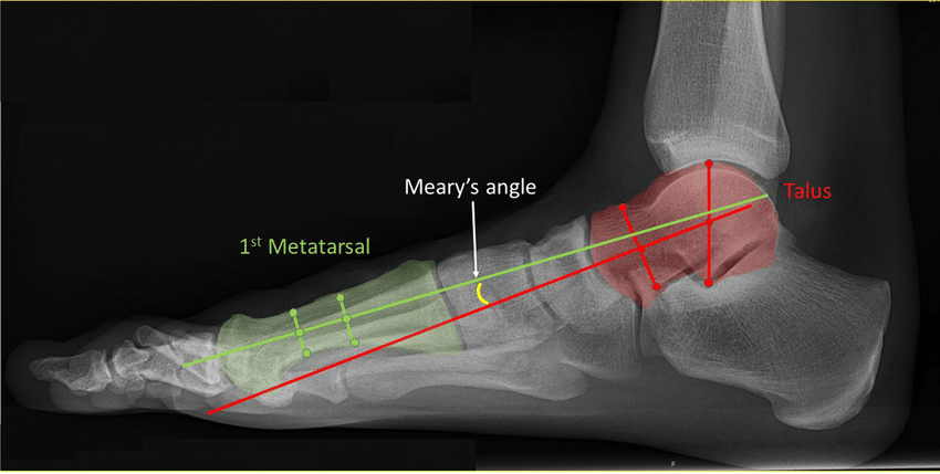 扁平足の新たな病期分類と運動療法｜理学療法士による臨床のためのnote