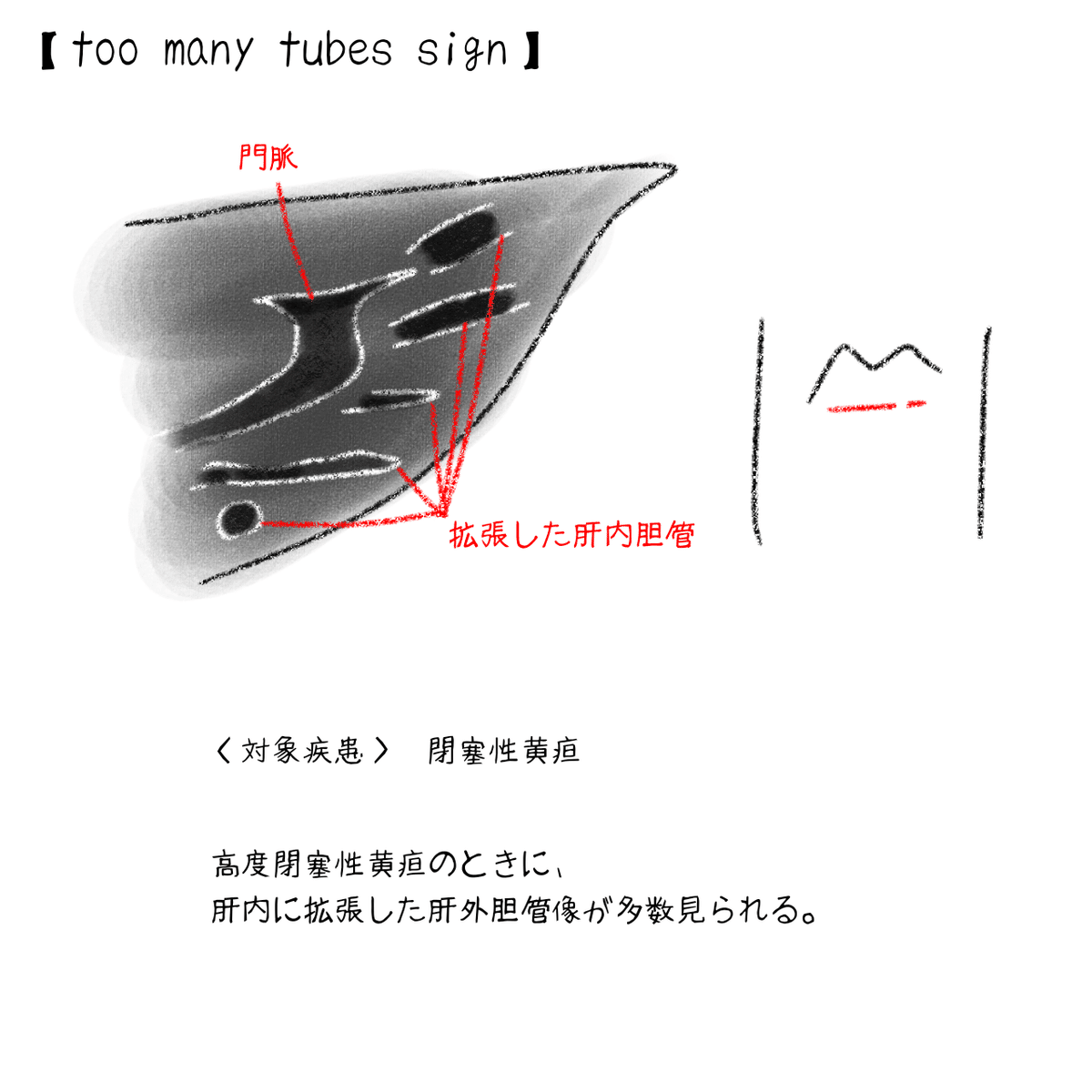 エコーサイン：胆管｜てがきのぎし