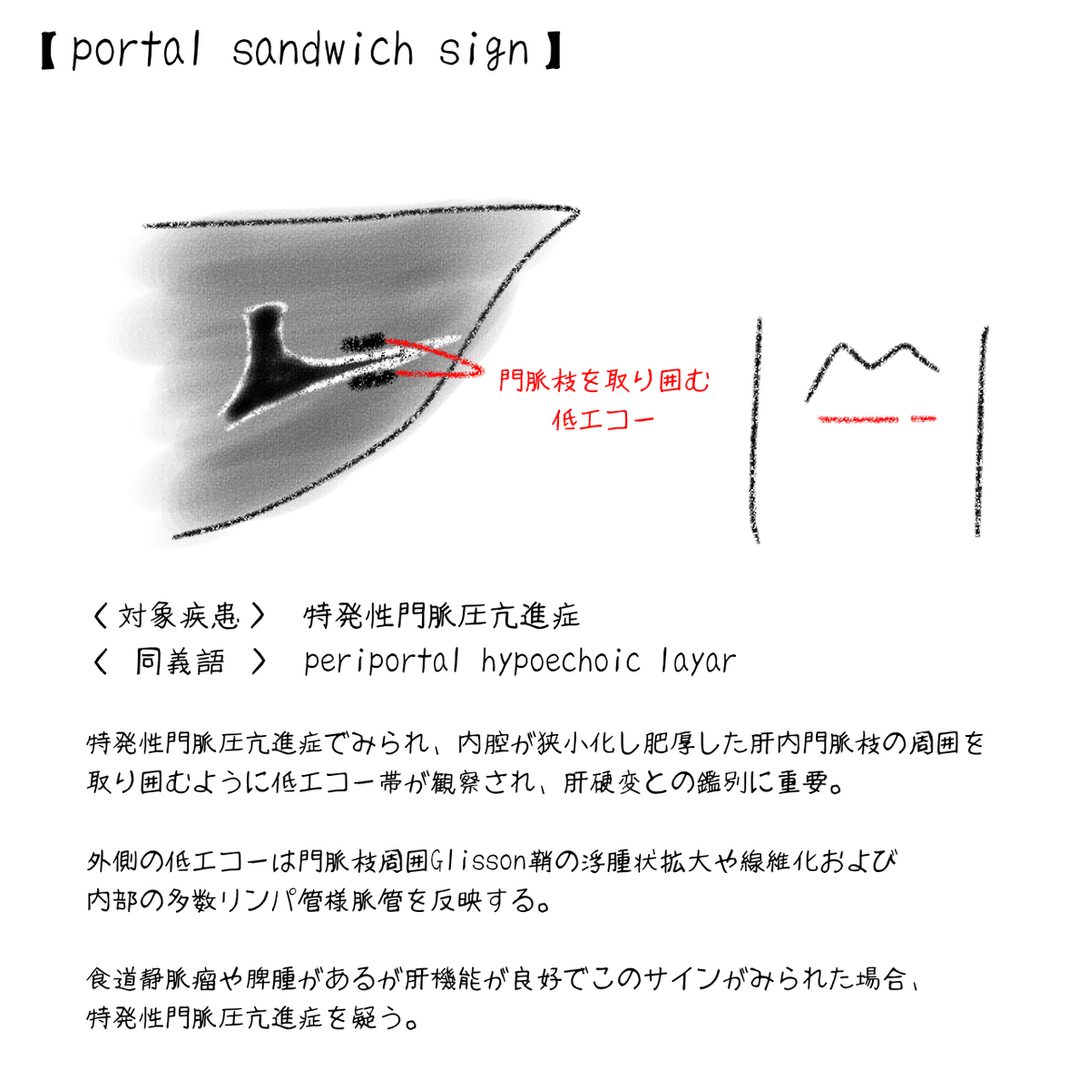 エコーサイン：胆管｜てがきのぎし