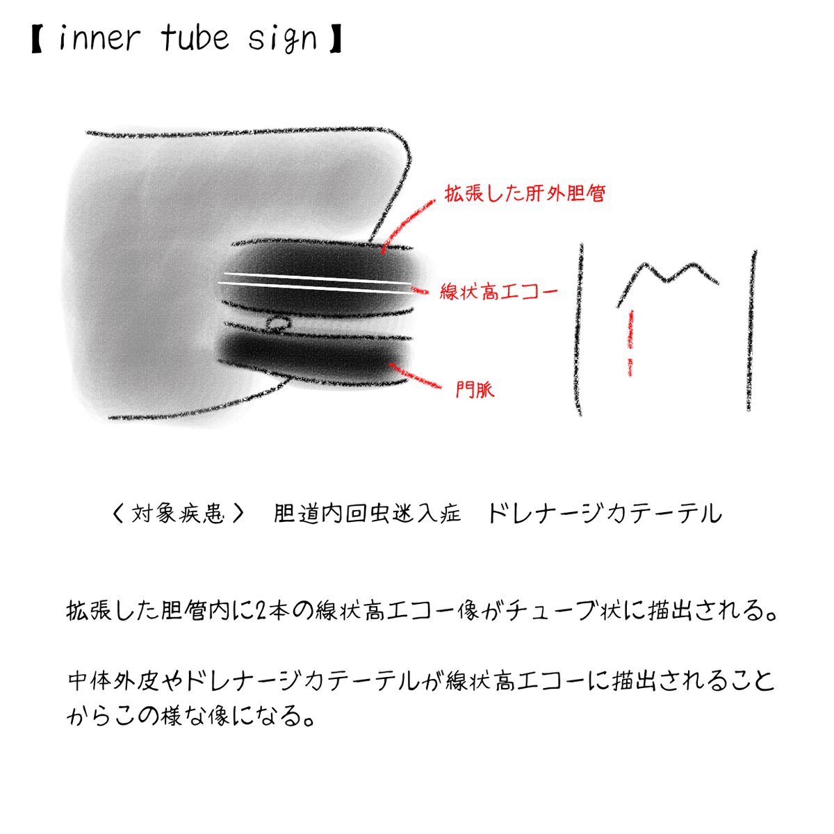 エコーサイン：胆管｜てがきのぎし