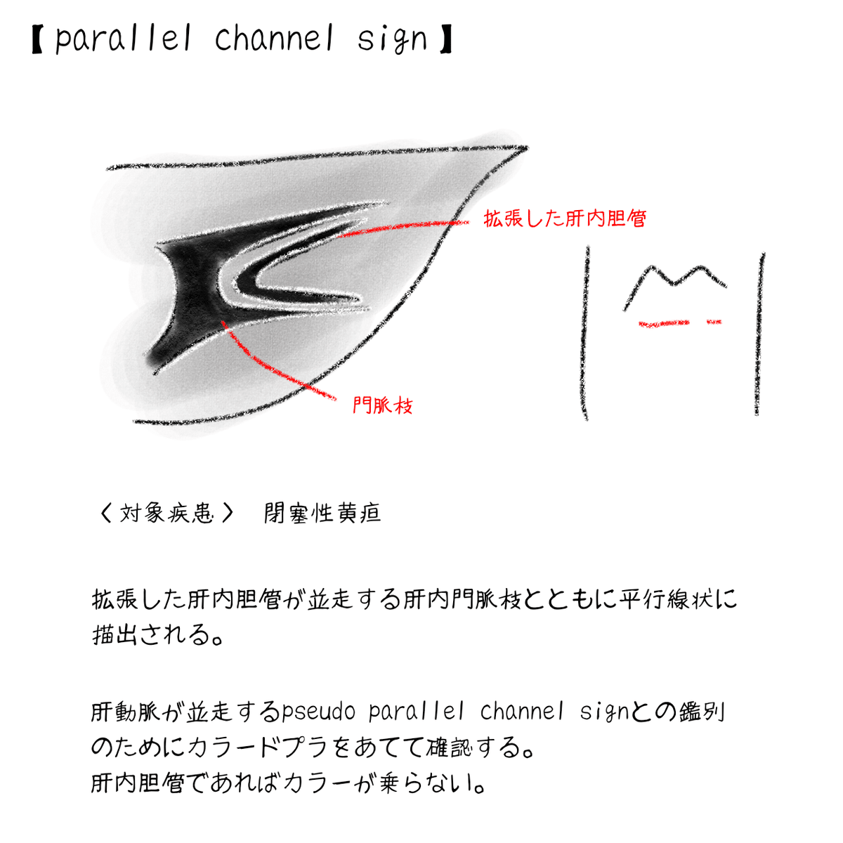 エコーサイン：胆管｜てがきのぎし