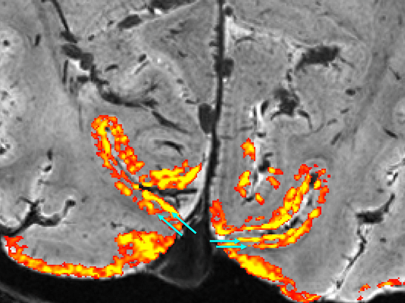 人の生きた脳の機能接続も透けて見えるfMRI｜東京 AI 研究所