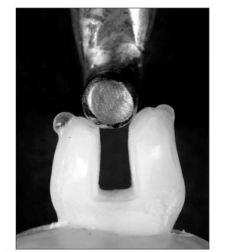 「58, 咬頭のたわみに及ぼす修復処置の影響」｜uni